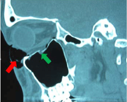 Periorbital Emphysema due to Coughing after a Sportsrelated Facial ...