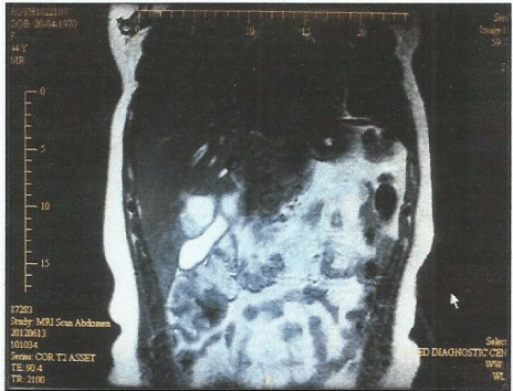Duplicate Gallbladder: Overview and Management Challenges
