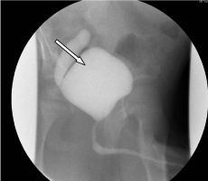 Epididymitis Due to Bilateral Ectopic Vas Deferens and Anorectal ...