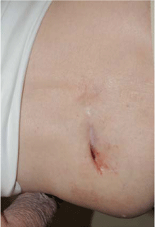 A Nephrocutaneous Fistula Presenting as a Chronic Back Wound
