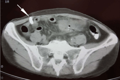 Colorectal Perforation from a Drainage Tube