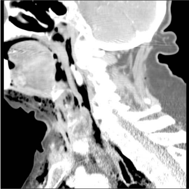 Abscess of the Tongue Evolution and Treatment of an Emergency