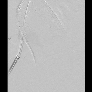 Treatment of Bilateral Iliac Aneurysms with Gore Iliac Branch ...