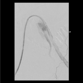 Treatment of Bilateral Iliac Aneurysms with Gore Iliac Branch ...