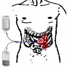 Transverse Abdominal Incision for Encapsulated Peritoneal Sclerosis: A ...