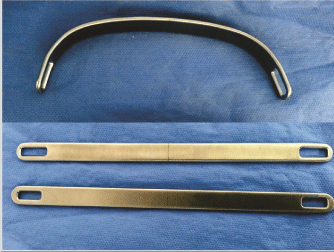 Moon Bridge Bar Stabilization: The Way Forward for Bar Stabilization in ...