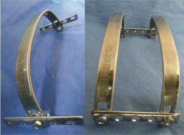 Moon Bridge Bar Stabilization: The Way Forward for Bar Stabilization in ...