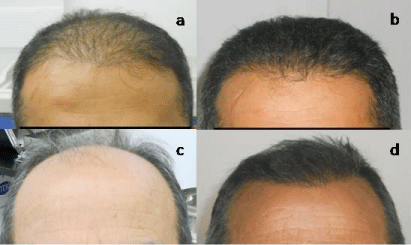 Evolution of Hair Transplantation