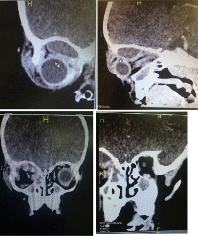 A Case Report of Orbital Abscess Complicating Ethmoidal Sinusitis in 15 ...