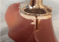 The Corail ® Stem: Does a Collar Improve the Immediate Stability Even ...