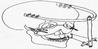 Dual Midfacial Distraction of Le Fort III minus I and Le Fort I ...