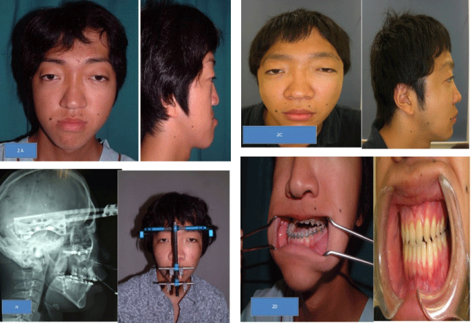 Dual Midfacial Distraction of Le Fort III minus I and Le Fort I ...