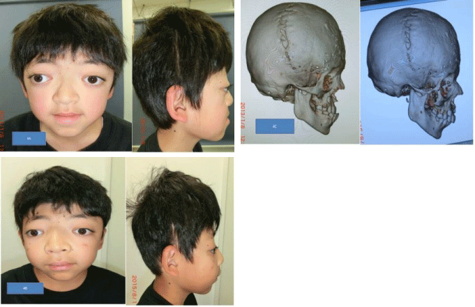Dual Midfacial Distraction of Le Fort III minus I and Le Fort I ...