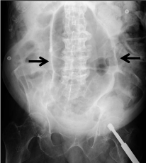 >Surgical Treatment of Cecal Volvulus