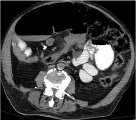 >Surgical Treatment of Cecal Volvulus