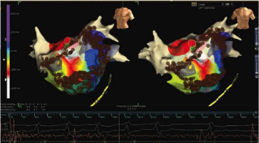 Cardiac Surgery for Arrhythmias