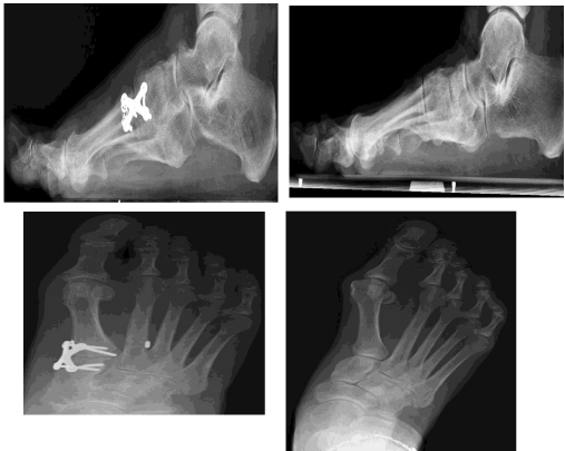 Hallux Valgus Correction by Opening Wedge Lapidus Fusion and ...