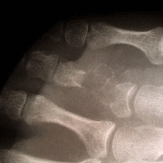 Chondrosarcoma of the Foot: A Rare Occurrence in the Distal Phalanx of ...