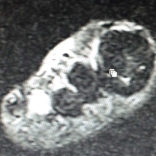 Chondrosarcoma of the Foot: A Rare Occurrence in the Distal Phalanx of ...
