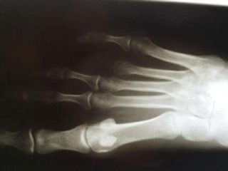 Chondrosarcoma of the Foot: A Rare Occurrence in the Distal Phalanx of ...