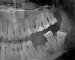 Surgical Management of Root Canal Overfill without Paresthesia: Case Report
