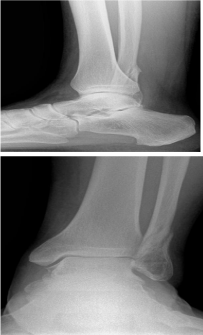 Mesenchymal Stem Cell Allograft in a Nonunion Fibular Fracture: A Case ...