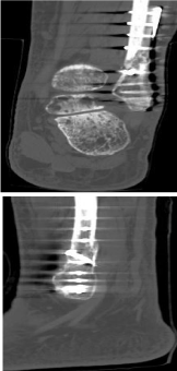 Mesenchymal Stem Cell Allograft in a Nonunion Fibular Fracture: A Case ...