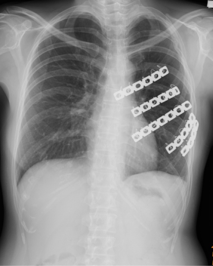 Lately Recognized Left Main Bronchial Rupture and Fail Chest