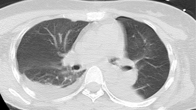 Lately Recognized Left Main Bronchial Rupture and Fail Chest