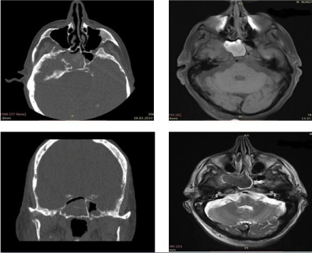 Isolated Sphenoid Sinus Pathology: Retrospective Analysis of 7 Cases