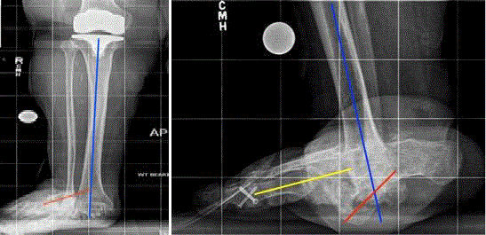 Midfoot and Hindfoot Charcot Joint Deformity Correction with Hexapod ...