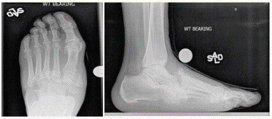 Midfoot and Hindfoot Charcot Joint Deformity Correction with Hexapod ...