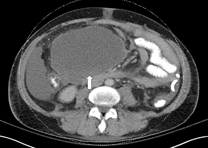 Necrotizing Pancreatitis: Advances in Management