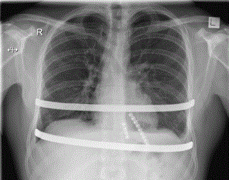 Evaluation and Surgical Treatment of Adult Pectus Excavatum Patients