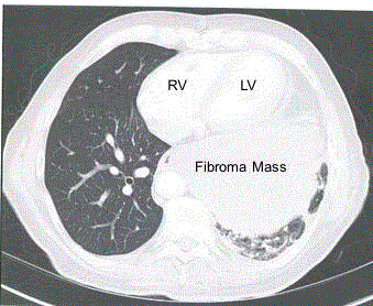 Continual Recurrent Solitary Pleural Fibrous Tumour