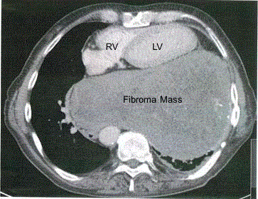 Continual Recurrent Solitary Pleural Fibrous Tumour