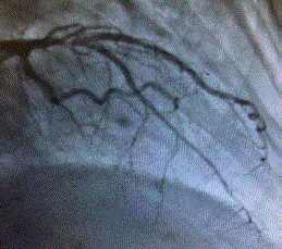 Deep Intramuscular Left Anterior Descending (LAD) Artery: Implications ...