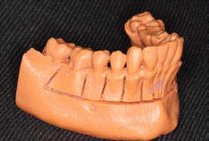 Guide Surgery Corticotomy System (GSCS) a New Device in Orthodontic ...