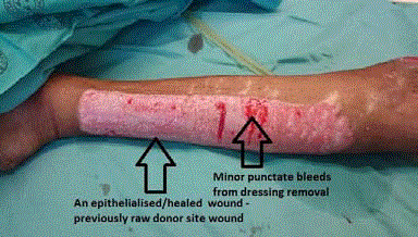 A Novel Technique for Composite Cultured Epithelial Autograft in a ...
