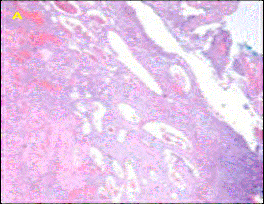 Abnormal Localization by Tagged RBC Scan in a Patient with Duodenal ...