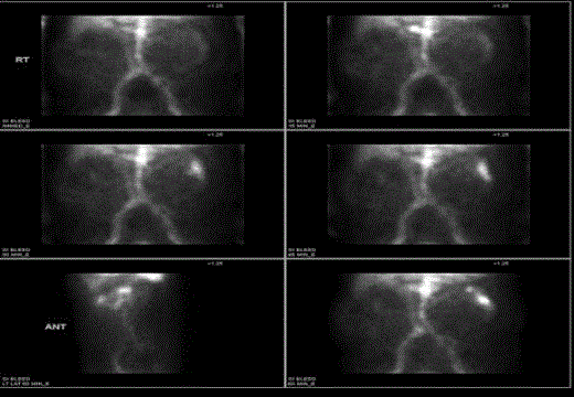 Abnormal Localization by Tagged RBC Scan in a Patient with Duodenal ...