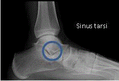 Medical Necessity and Evidence Basis for Extra-osseous Talotarsal Joint ...