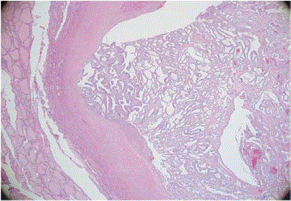 Cribriform Morular Variant of Papillary Thyroid Cancer: An Indication ...