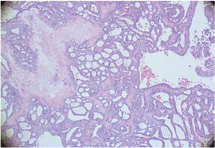 Cribriform Morular Variant of Papillary Thyroid Cancer: An Indication ...