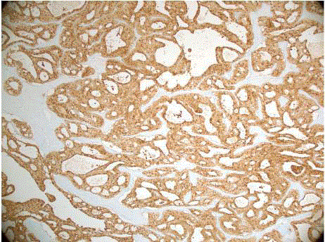 Cribriform Morular Variant of Papillary Thyroid Cancer: An Indication ...