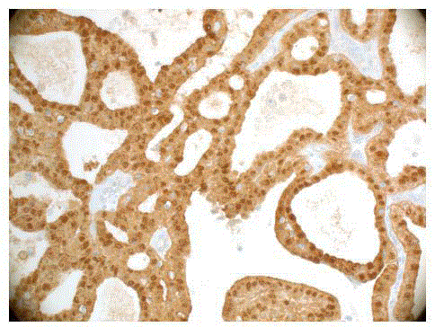 Cribriform Morular Variant of Papillary Thyroid Cancer: An Indication ...