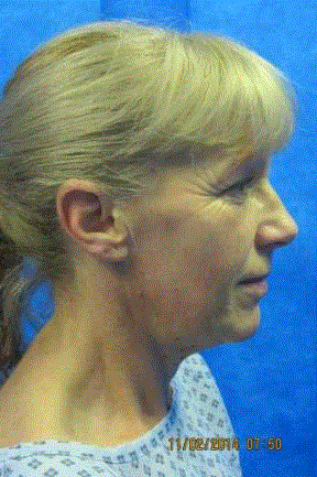 Aesthetica in Practice: The Flick Lift in Assisting Closure of Large ...