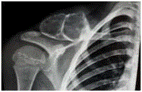 Aneurysmal Bone Cyst of Clavicle in a Child: A Rare Case Report