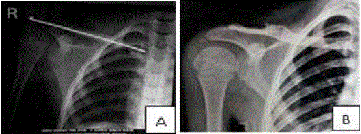 Aneurysmal Bone Cyst of Clavicle in a Child: A Rare Case Report