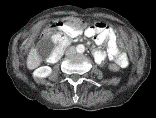 Ectopic Localization of the Gallblader at Posterior Caecum and ...